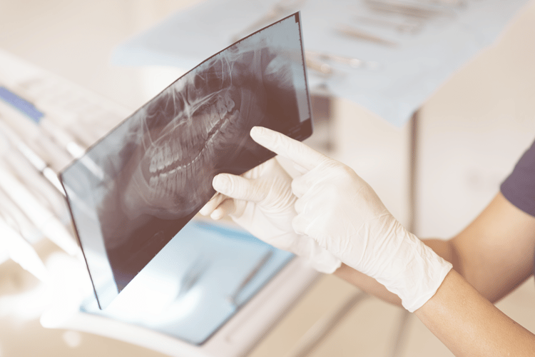 Dental X-Rays - Why They Are Important