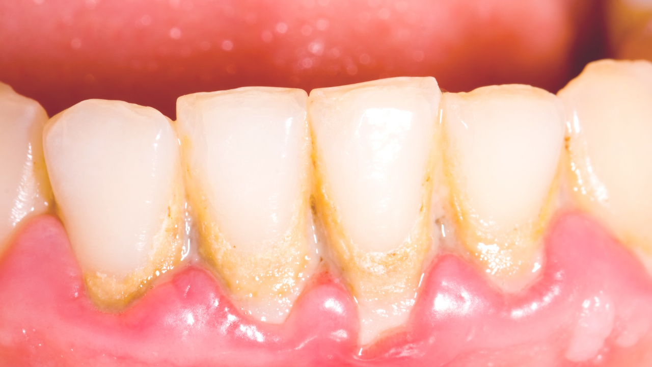 Combatting Plaque Buildup: A Guide to Preventing Tooth Decay
