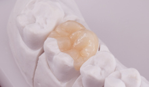 Fillings vs Onlays: Making the Right Choice