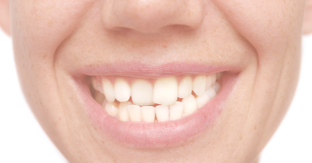 Crooked Teeth: Causes, Risks, and Treatment